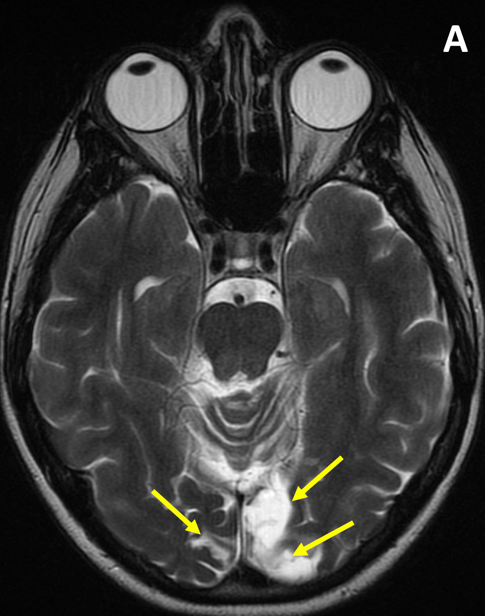 Encephalomalacia - MRI Online / Medality
