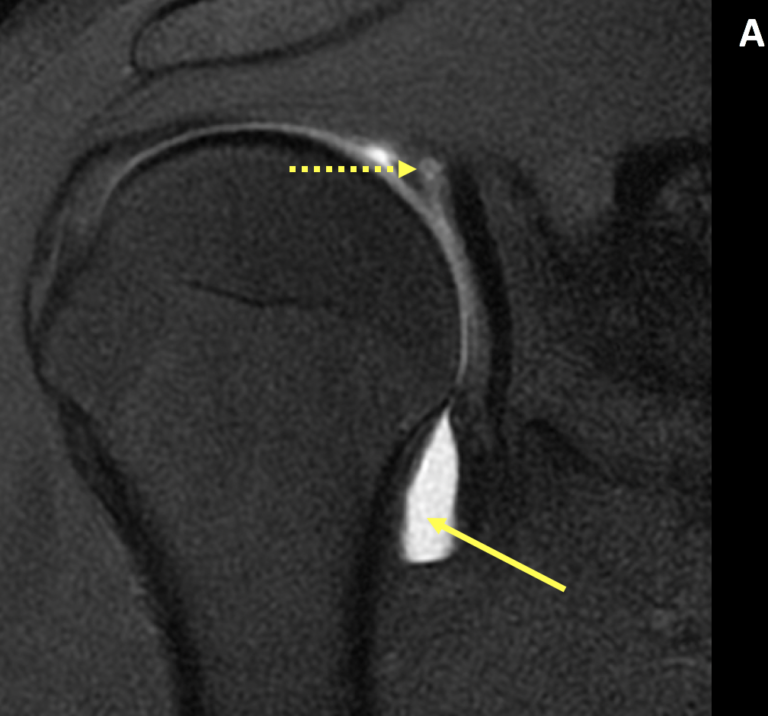 Spinoglenoid notch cyst (SGNC) - MRI Online / Medality