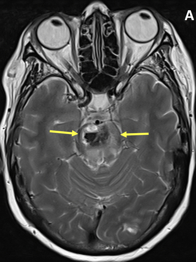 Intracranial Hemorrhage (ICH) - MRI Online / Medality