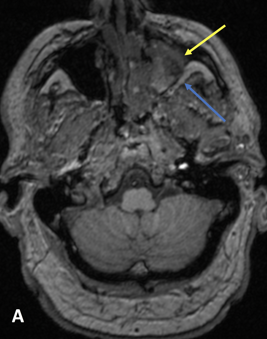 Inverted Papilloma (IP) - MRI Online / Medality