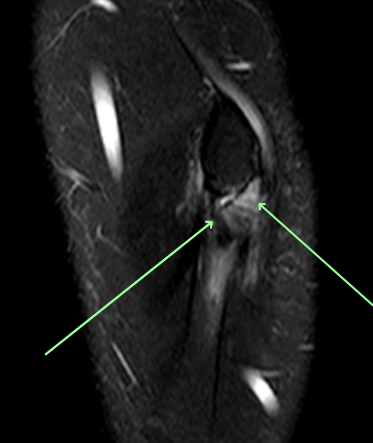 Ulnar Collateral Ligament (UCL) tear - MRI Online / Medality