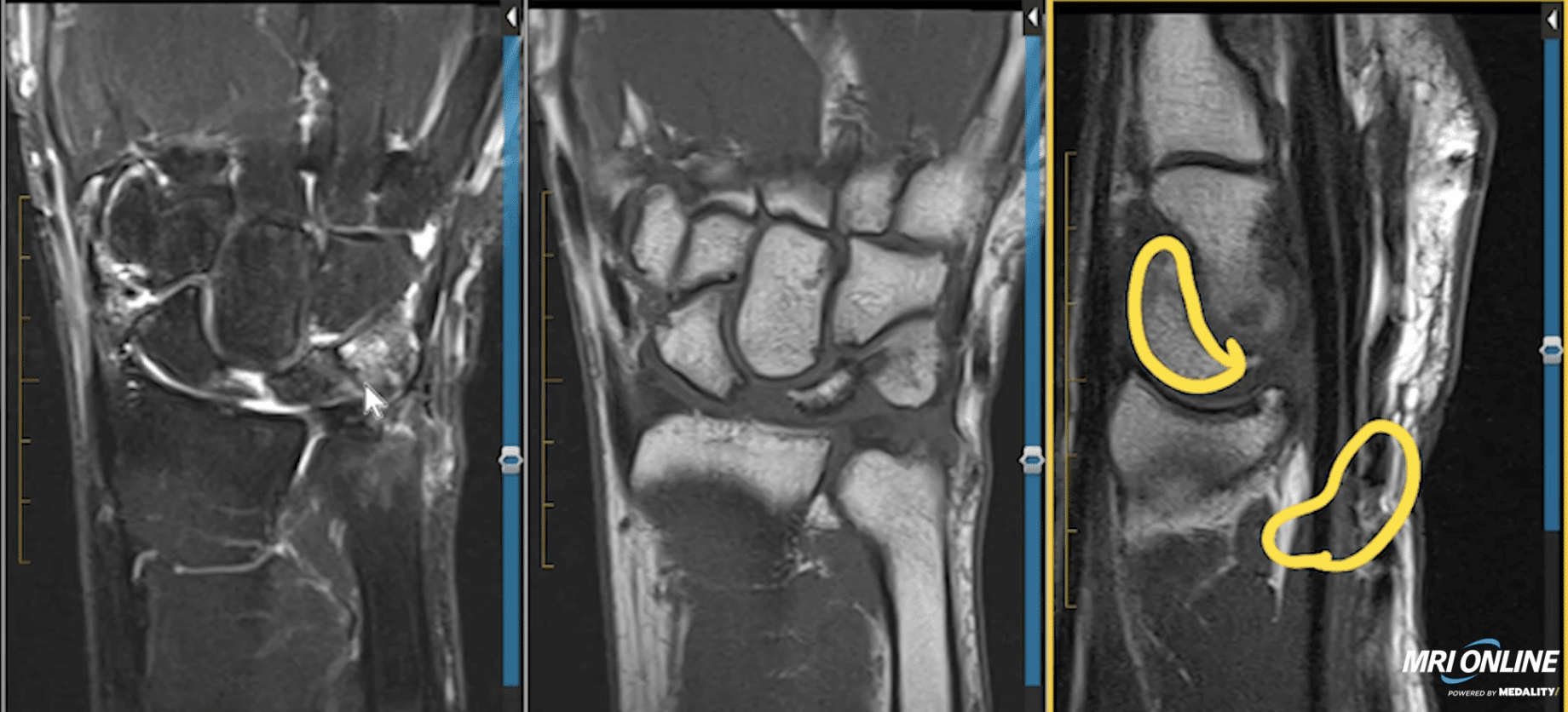 Hand & Wrist MRI Fellowship Certificate - Musculoskeletal Imaging ...