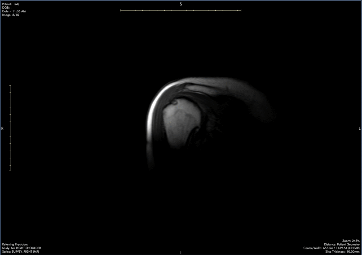 Infraspinatus Tendinopathy | MSK Shoulder MRI Case Review with Dr ...