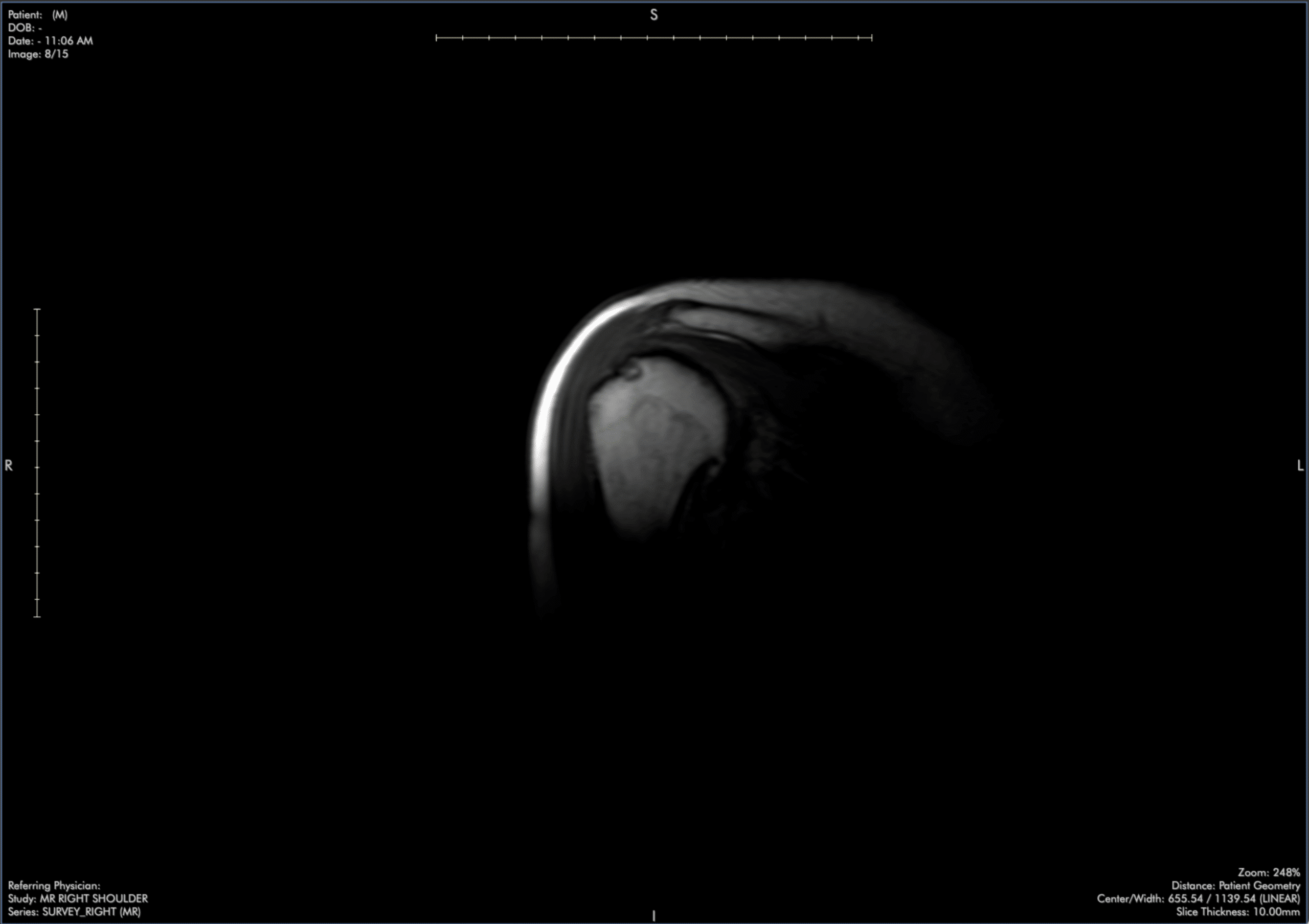 Infraspinatus Tendinopathy | MSK Shoulder MRI Case Review with Dr ...