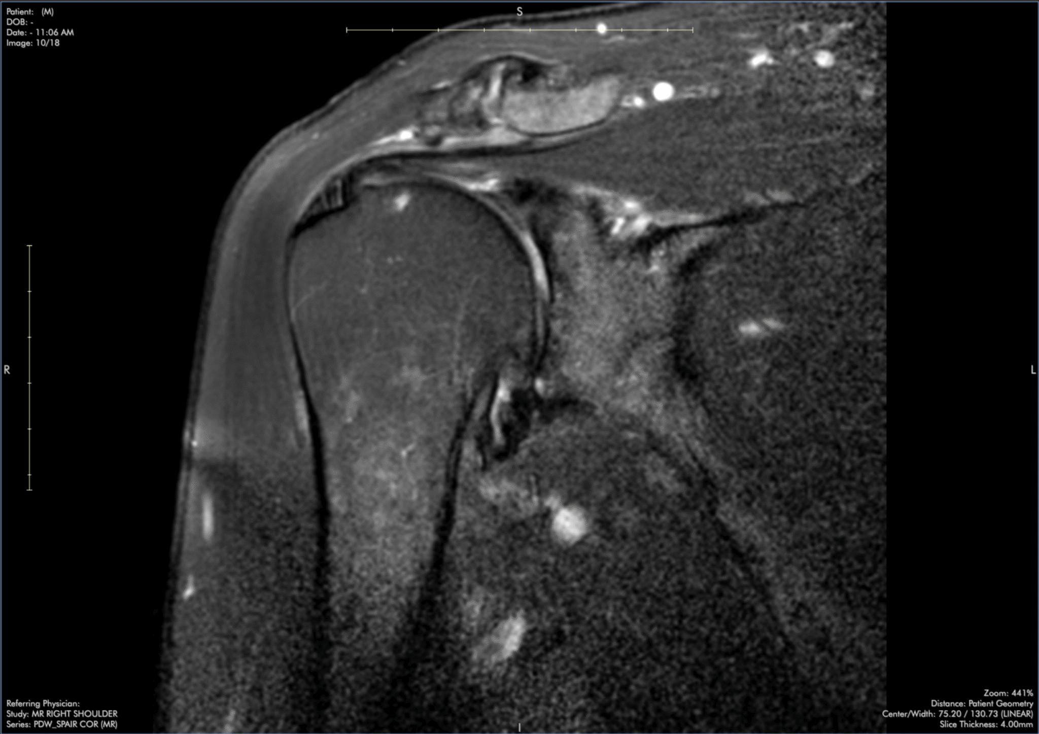 Infraspinatus Tendinopathy | MSK Shoulder MRI Case Review with Dr ...