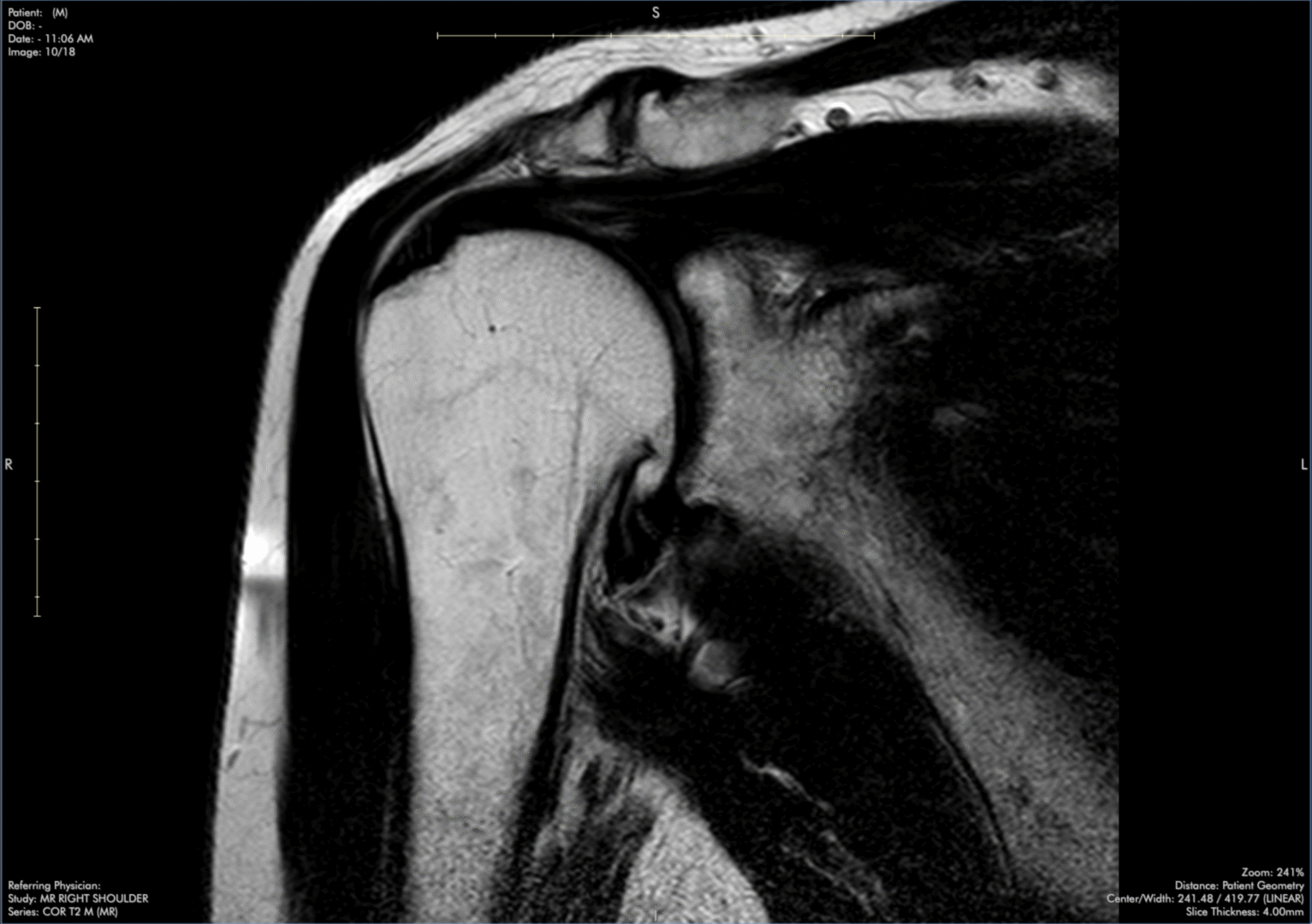 Infraspinatus Tendinopathy | MSK Shoulder MRI Case Review with Dr ...