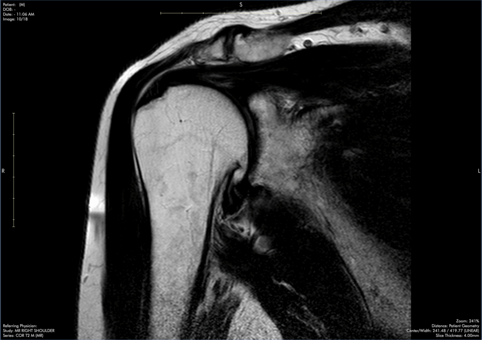 Infraspinatus Tendinopathy | MSK Shoulder MRI Case Review with Dr ...