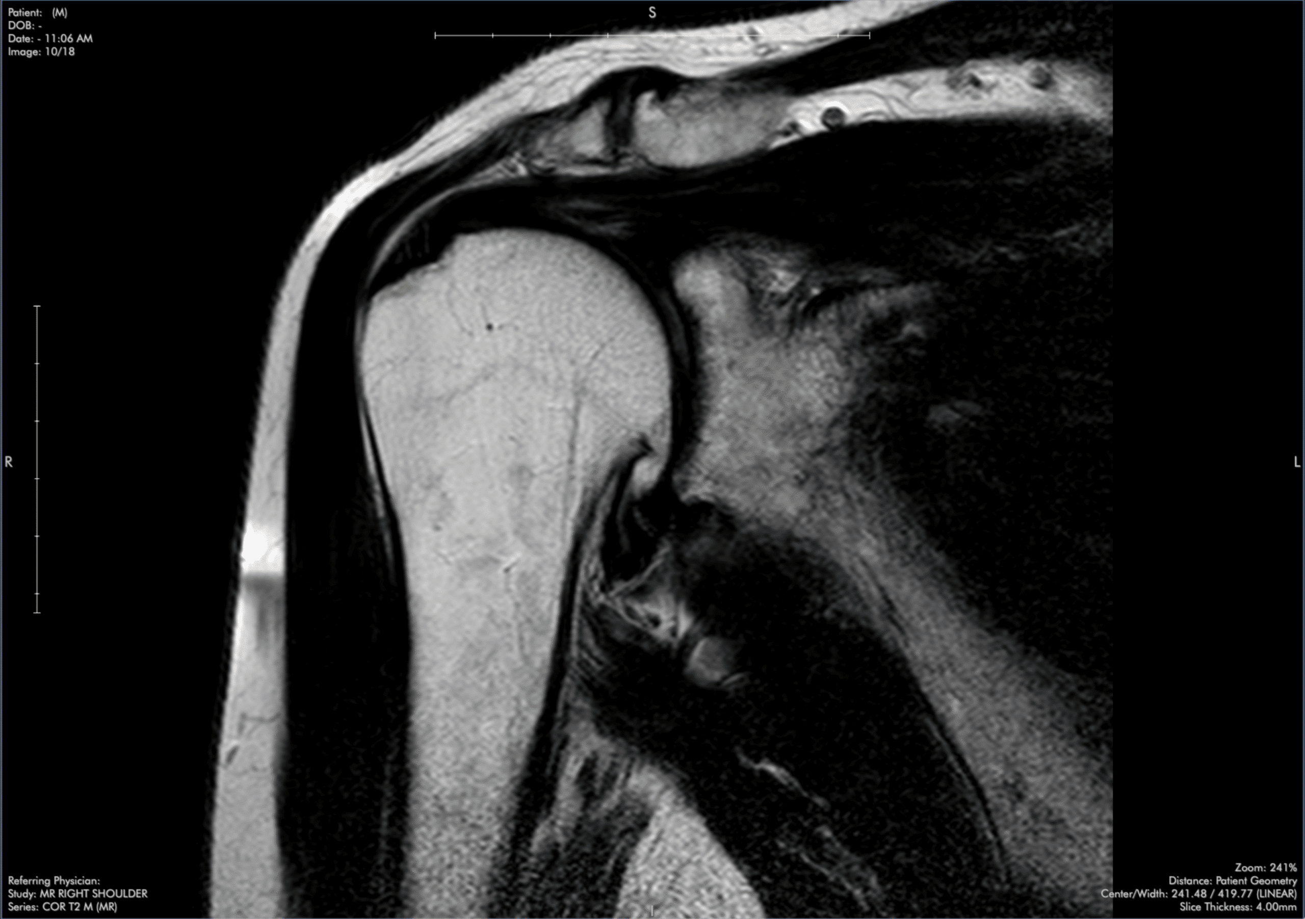 Infraspinatus Tendinopathy | Case Review with Dr. Pomeranz