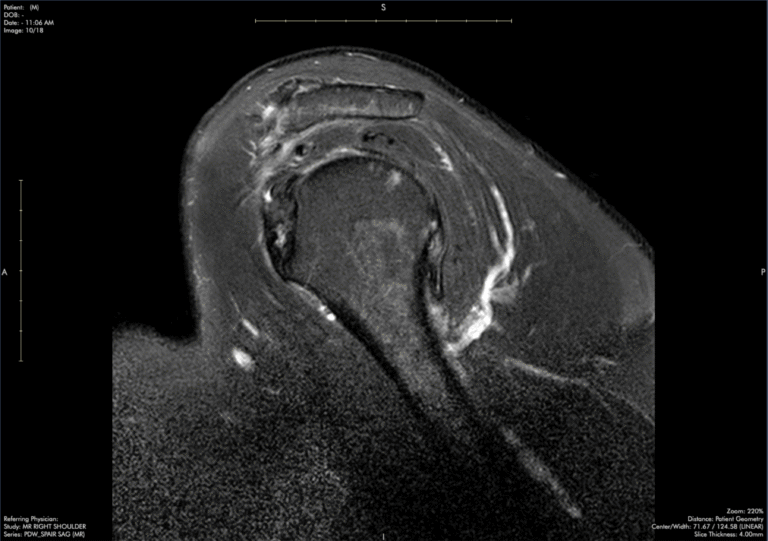 Infraspinatus Tendinopathy | Case Review with Dr. Pomeranz