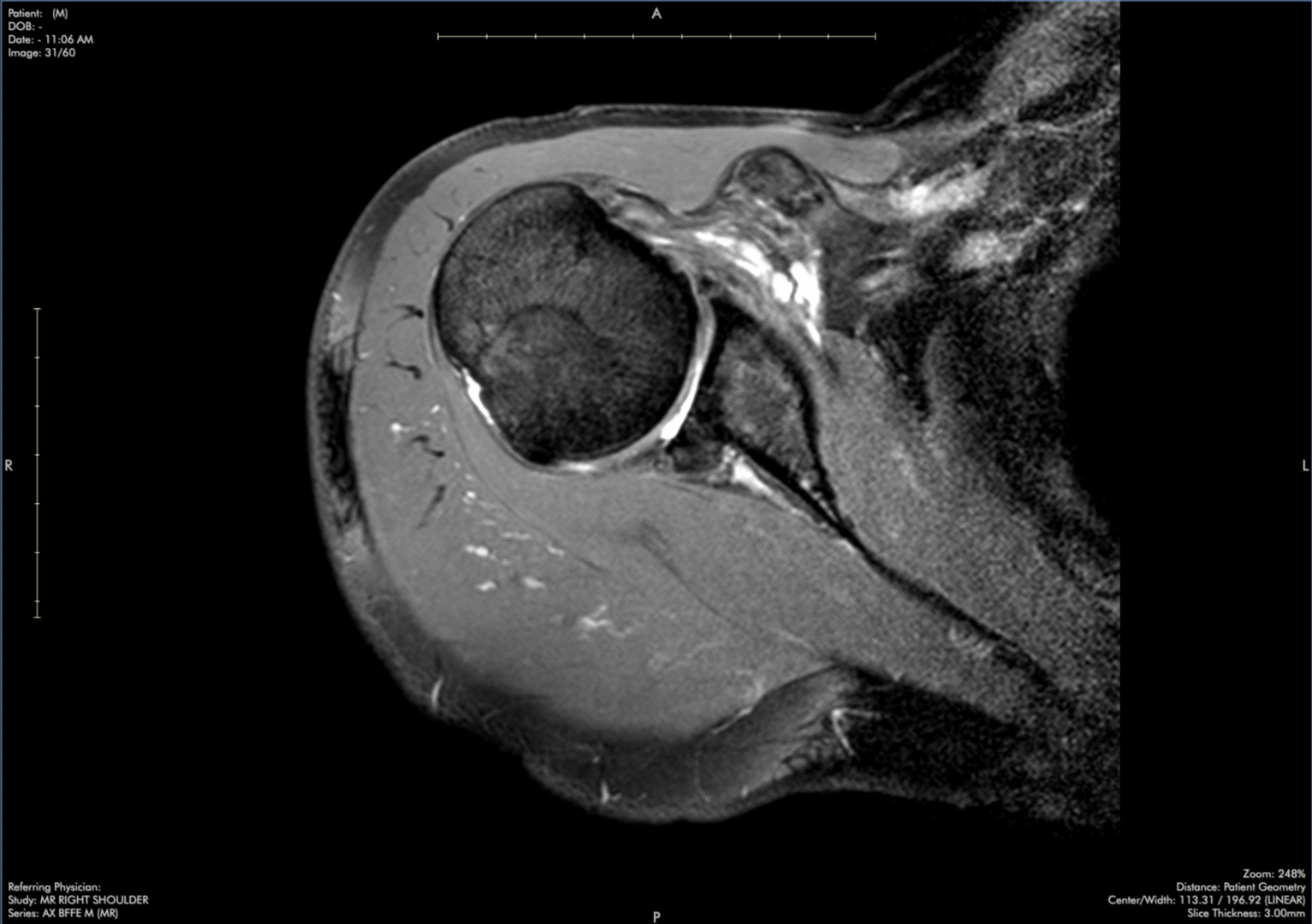 Infraspinatus Tendinopathy | Case Review with Dr. Pomeranz