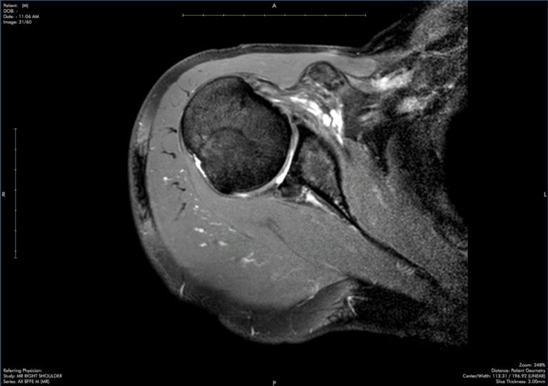 Infraspinatus Tendinopathy | Case Review with Dr. Pomeranz