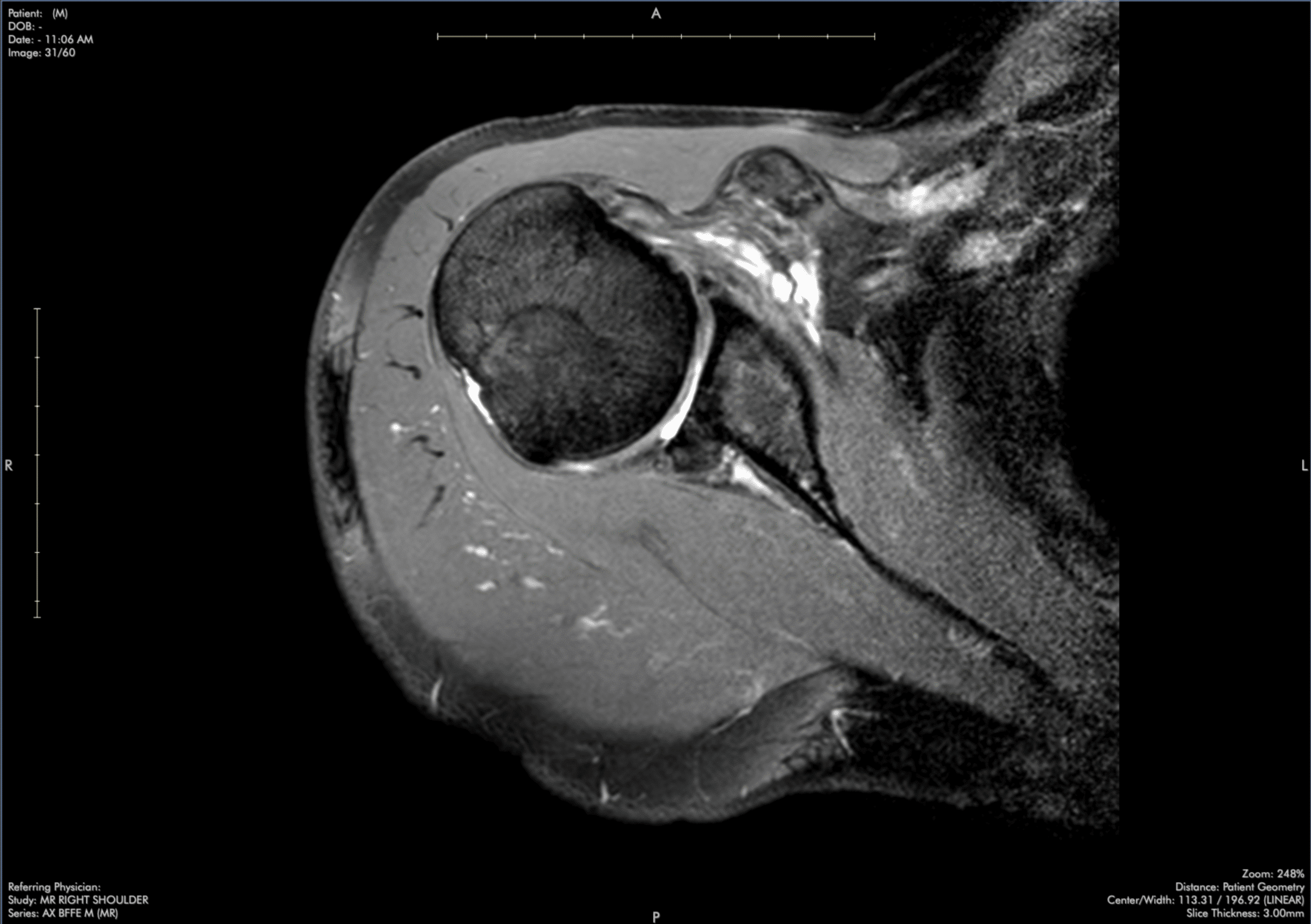 Infraspinatus Tendinopathy | Case Review with Dr. Pomeranz
