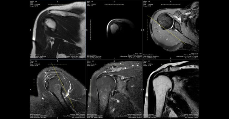 Infraspinatus Tendinopathy | MSK Shoulder MRI Case Review with Dr ...