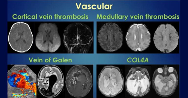 Neonatal Brain Imaging: A Radiologist’s Guide to Diagnosing the Newborn ...