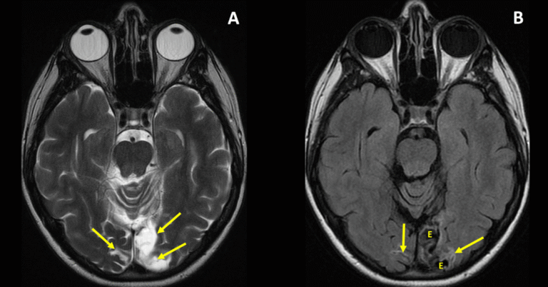 What Is Encephalomalacia? A Radiologist’s Guide to Understanding Brain Softening